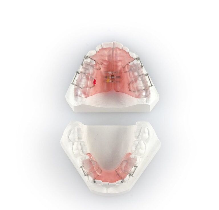 Twin Block Braces - The Bay Orthodontics