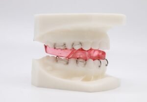 Twin Block Braces - The Bay Orthodontics